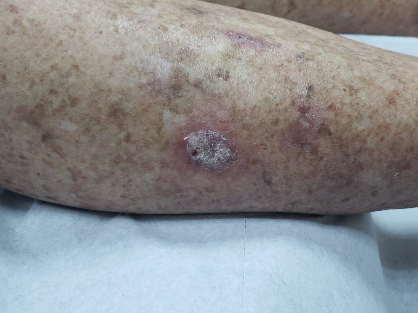 Sarcoma sinovial: síntomas, tratamientos y esperanza de recuperación